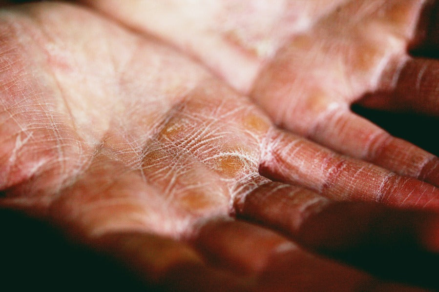 5 Essential Tips to Care for Rough, Dry Hands - Dr. Squatch